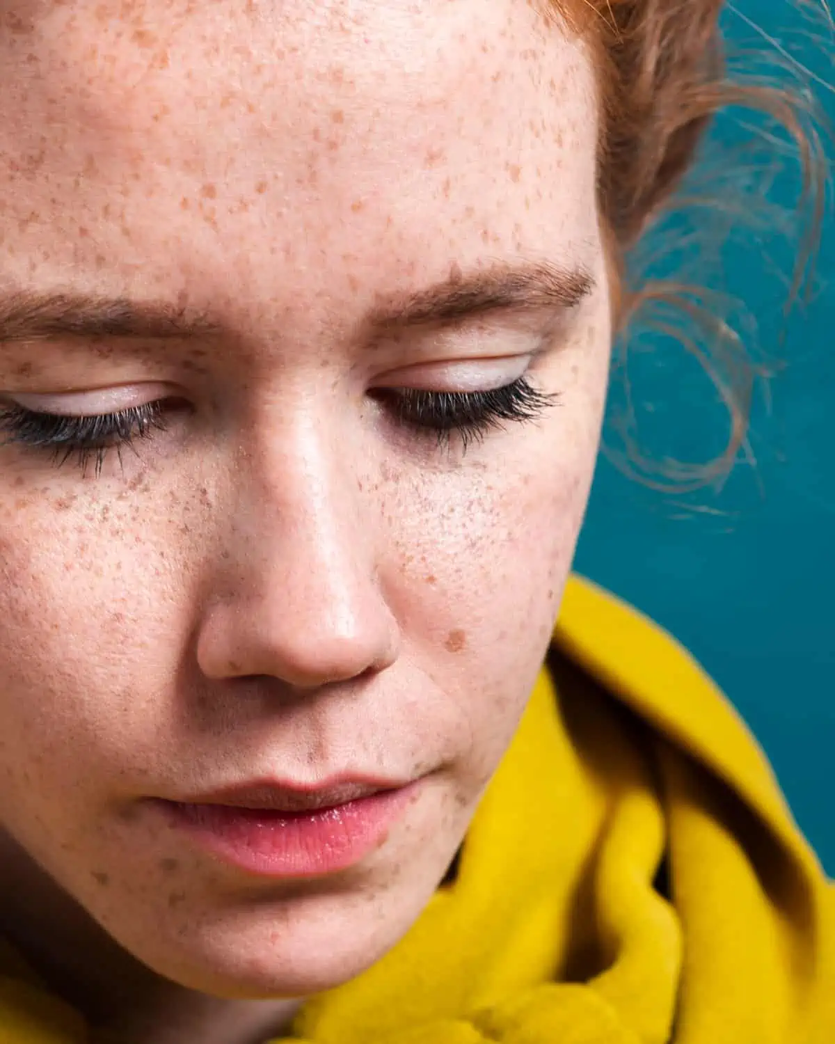 Removing Chickenpox Scars in Children: 13 Proven Tips and Tricks ...